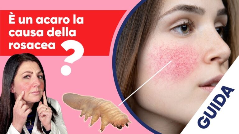 La Rosacea: Una Malattia Autoimmune | Actualizado diciembre 2025