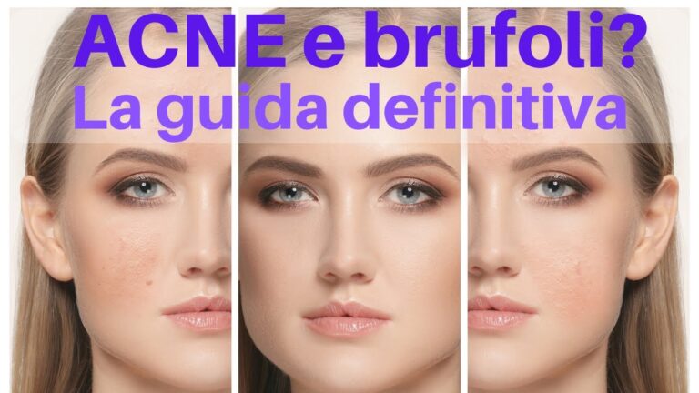 Rimedi naturali contro l'acne ormonale | Actualizado mayo 2026