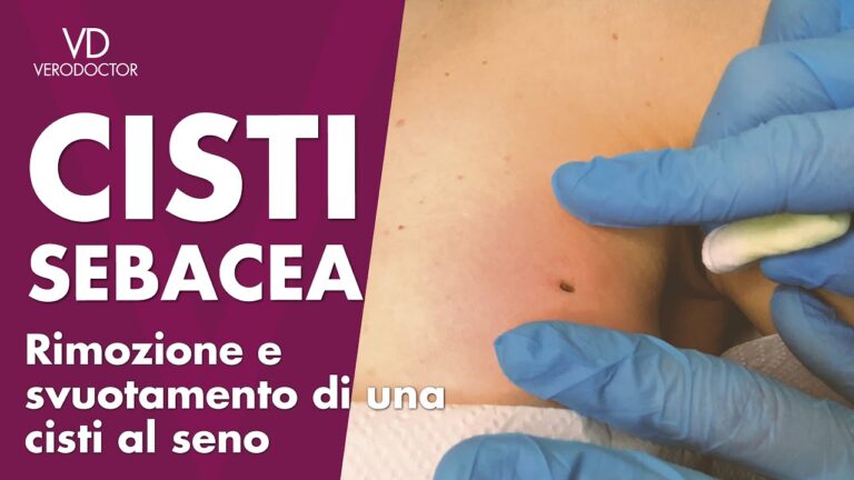 Come trattare le cisti infiammate al seno | Actualizado mayo 2026