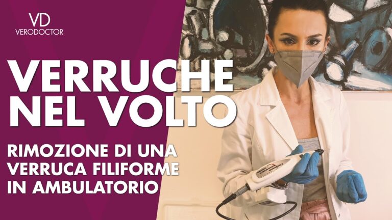 Come Rimuovere le Verruche dal Viso in Modo Efficace | Actualizado mayo ...