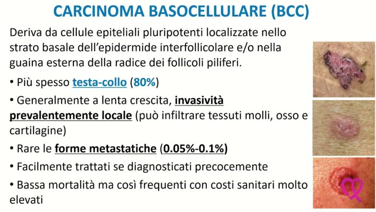 Il basalioma: possibilità di regressione spontanea | Actualizado ...